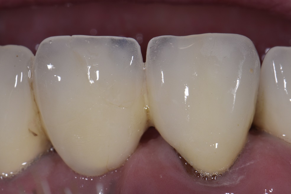 Porcelain Bridge Repair using GC's New Cement