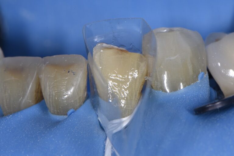 Derotating a tooth visually and building strength and esthetics