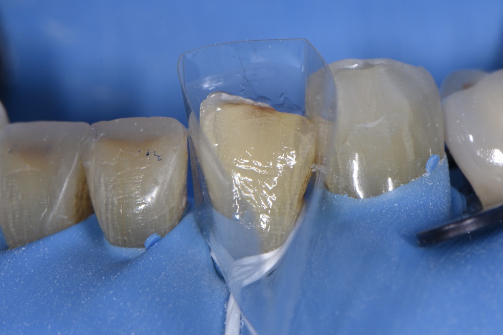 Derotating a tooth visually and building strength and esthetics