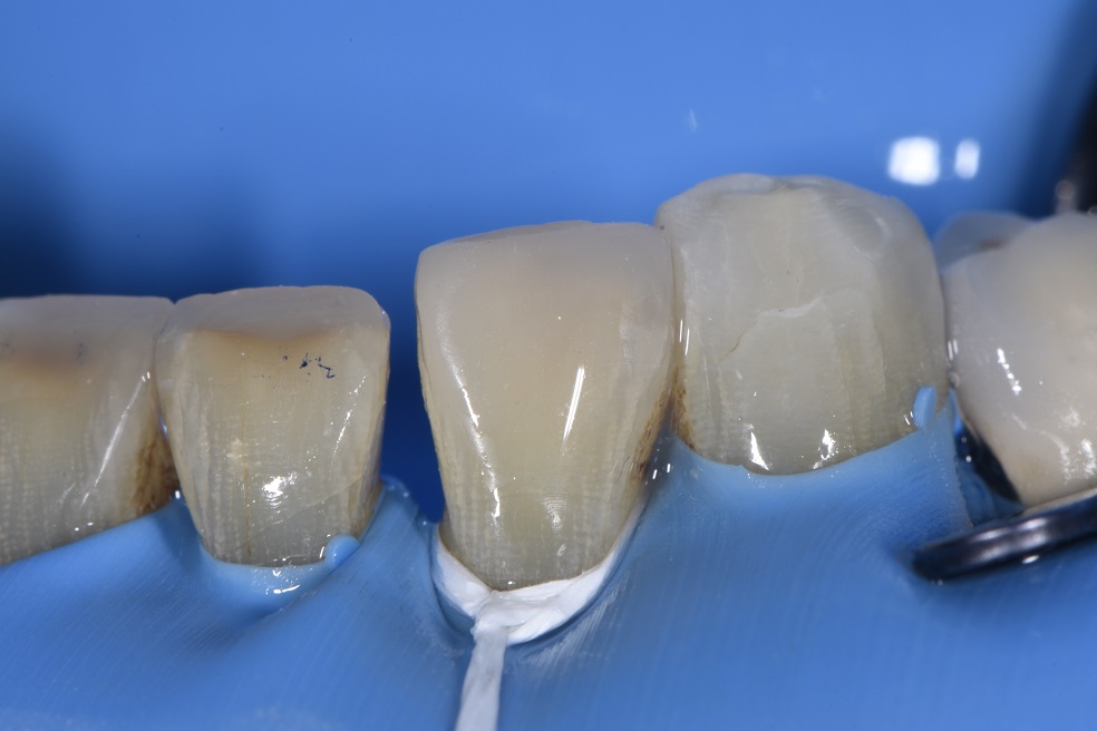Derotating a tooth visually and building strength and esthetics