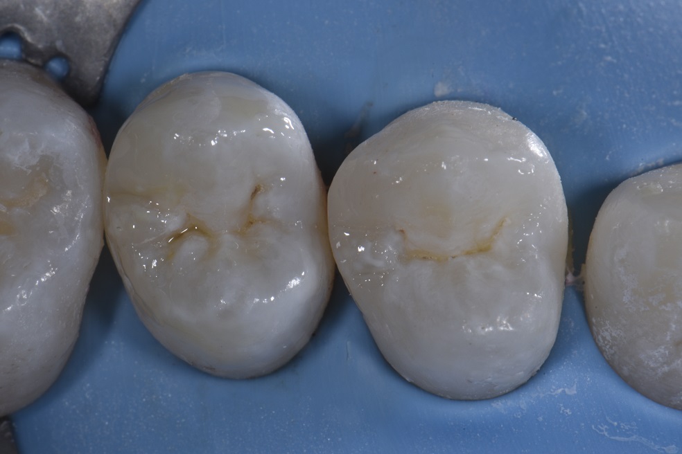 Minimally Invasive Tooth Preparation and Restorations
