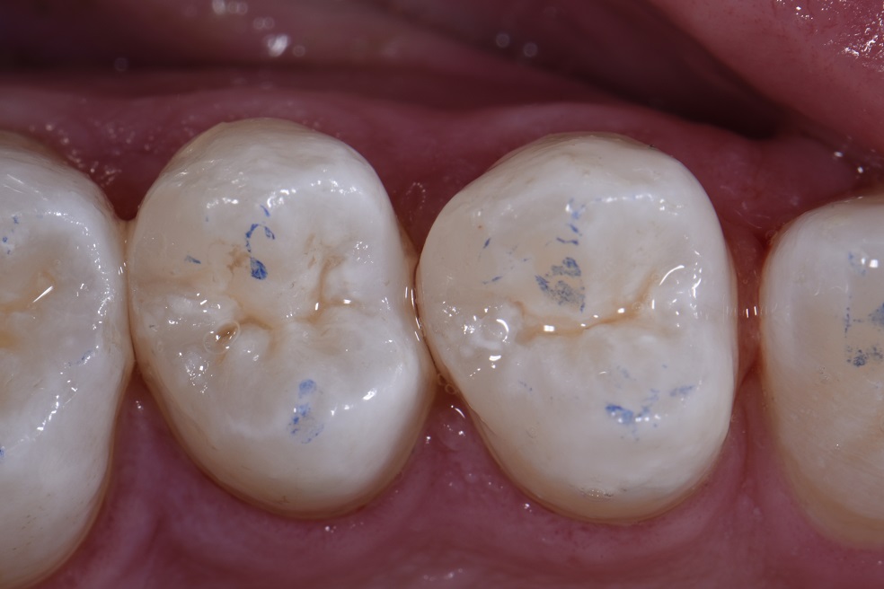 Minimally Invasive Tooth Preparation and Restorations