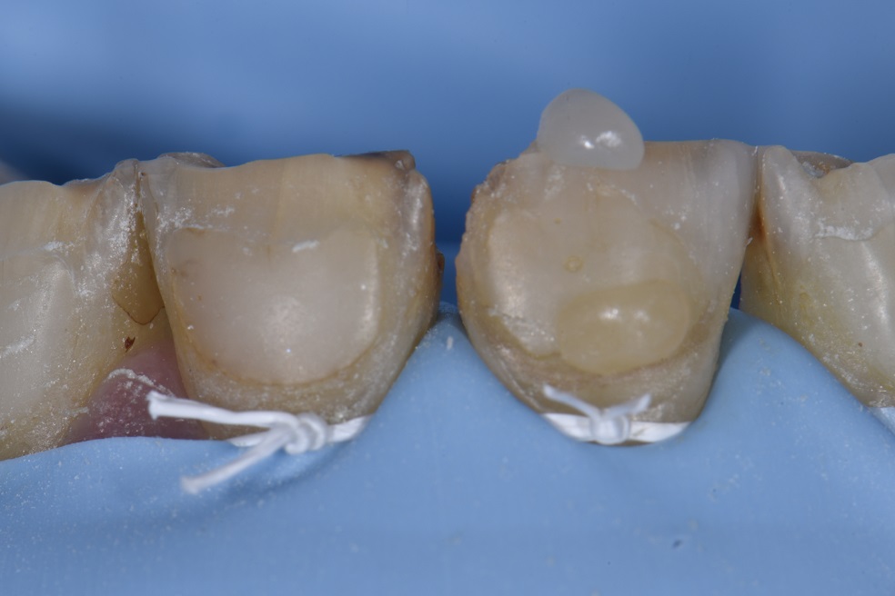 Simplicity in Composite Layering