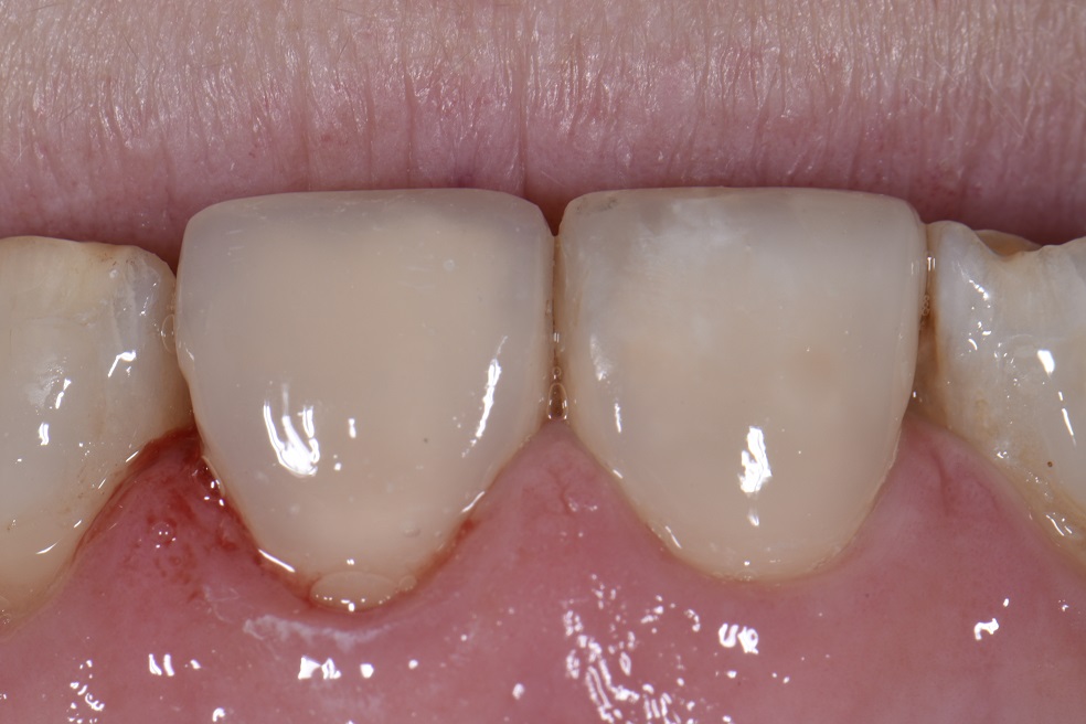 Simplicity in Composite Layering