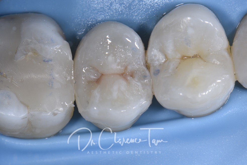 Amalgam Replacements with a Beautiful Composite Resin