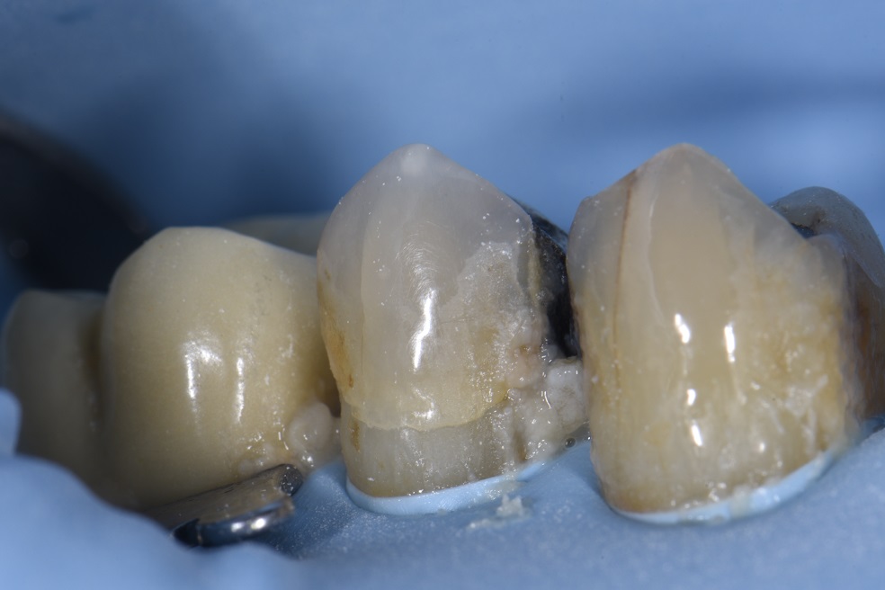 Onlay Provisionalization and Bonding