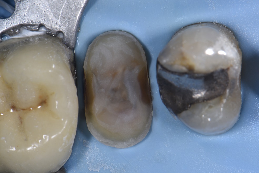 Onlay Provisionalization and Bonding