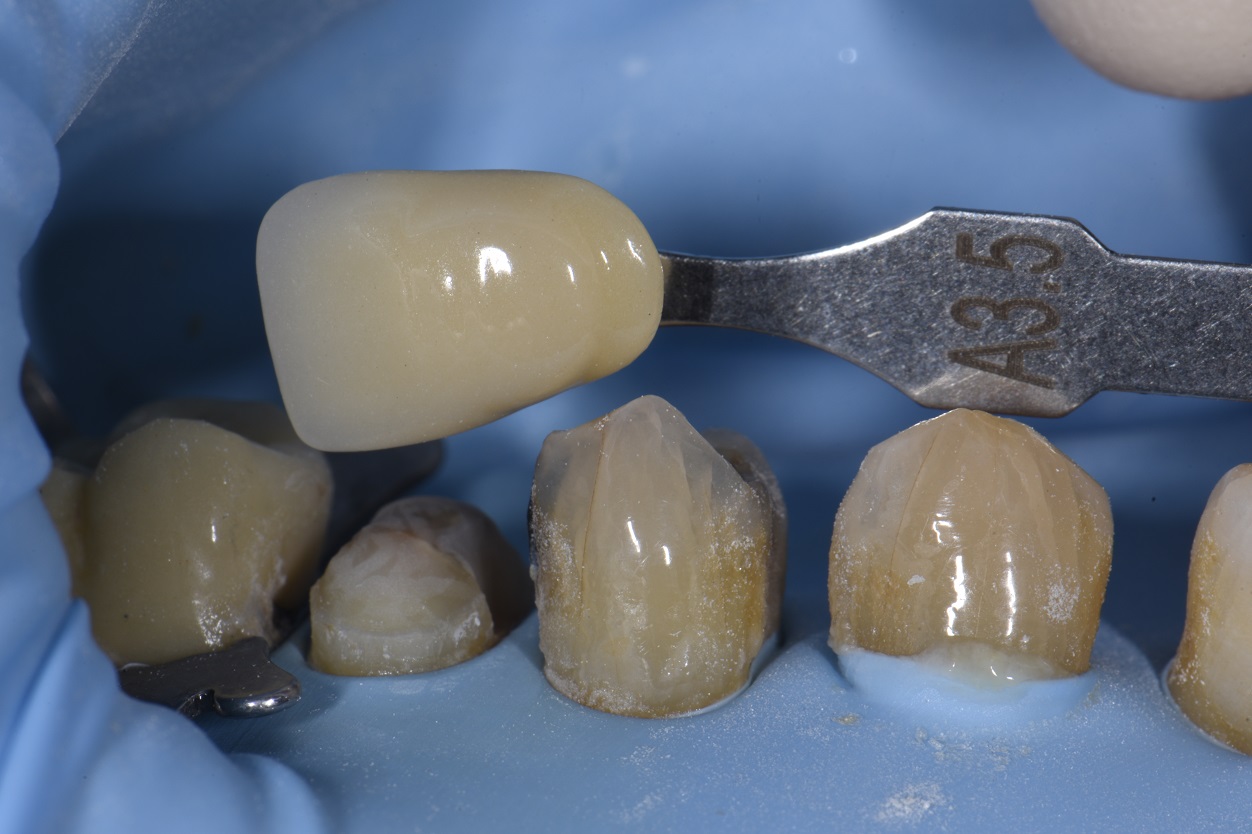 Onlay Provisionalization and Bonding