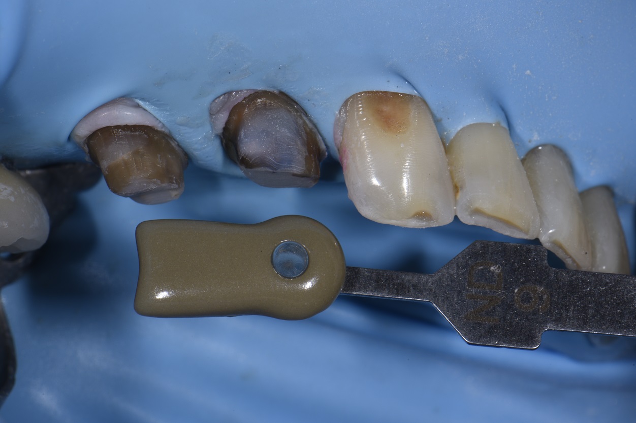 Reconstruction and whitening of heavily-broken down teeth
