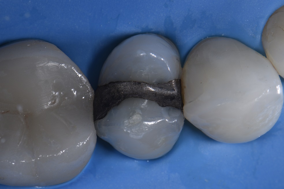 Amalgam restored teeth transformed to virgin appearance