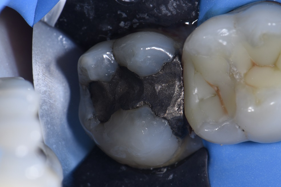 Blocking out dark amalgam staining with composite resin