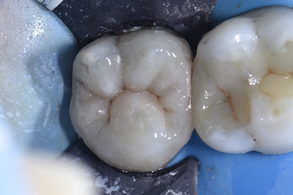 Blocking out dark amalgam staining with composite resin