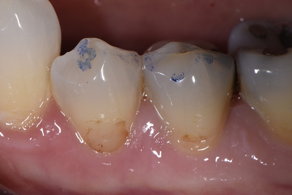 Dental Root Restorations with GC Essentia U