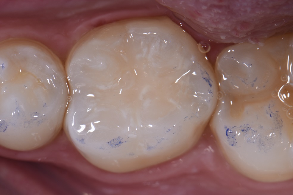Bioactive fissure sealants