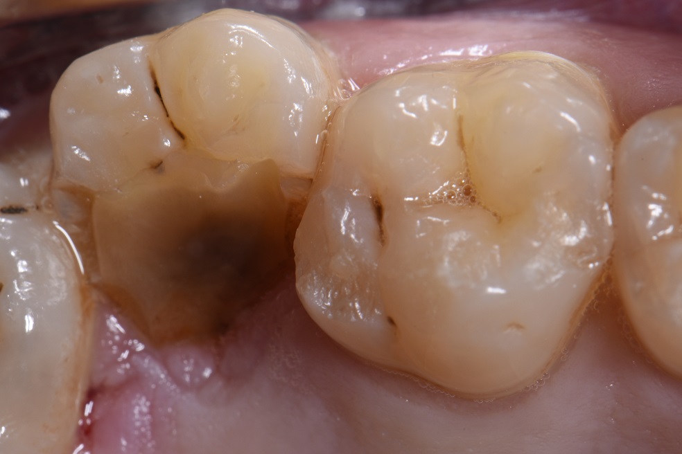 Complex reconstruction of a fractured molar in composite