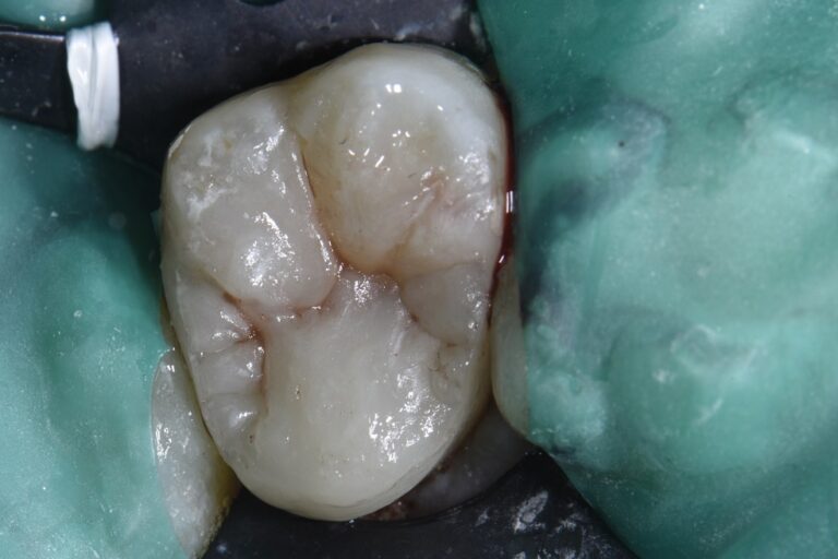 Complex reconstruction of a fractured molar in composite