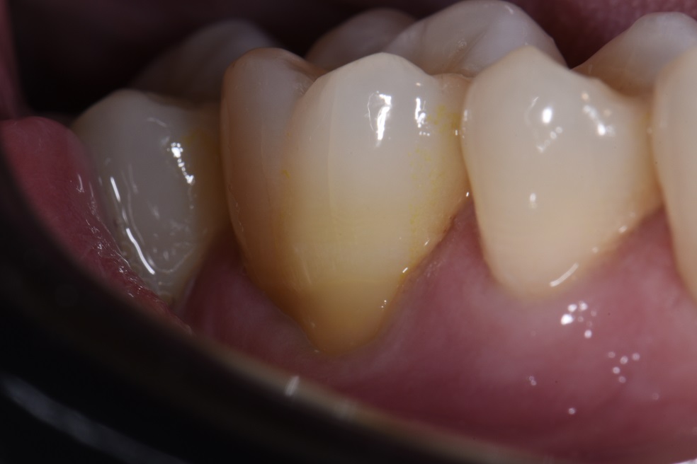 Conservative Root Protection