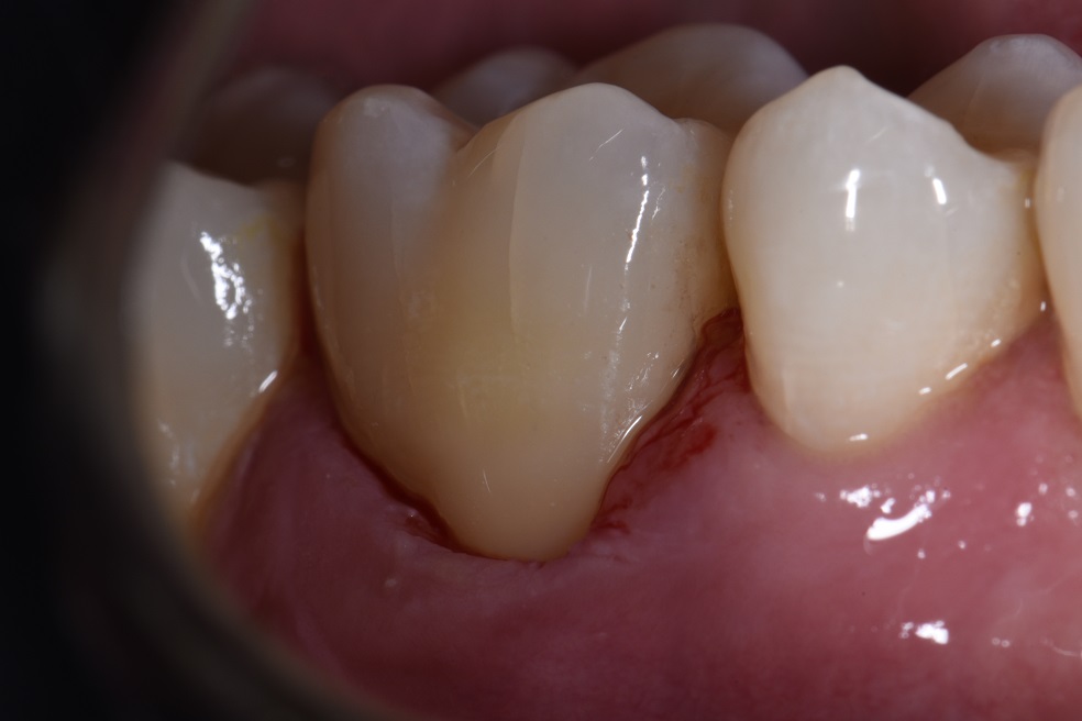 Conservative Root Protection