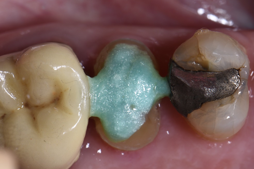 Onlay Provisionalization and Bonding