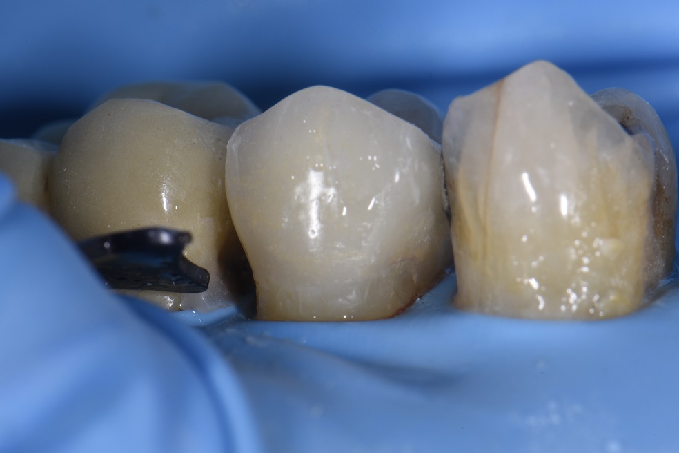 Onlay Provisionalization and Bonding