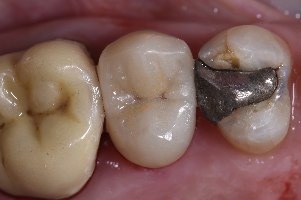 Onlay Provisionalization and Bonding