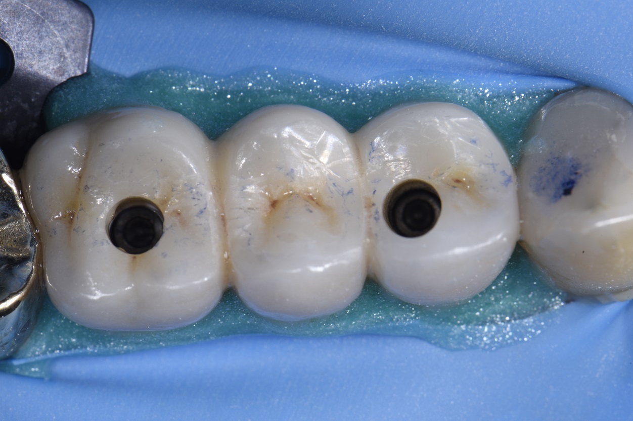 Ivoclar ZirCAD Prime Multi on Ti-base