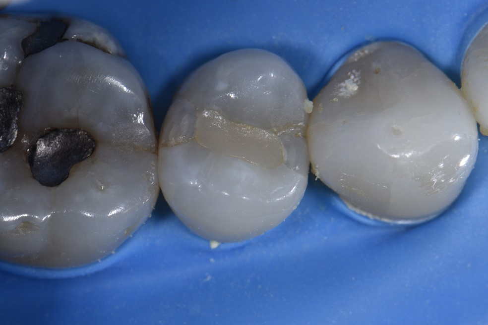 Dissecting out Cracks in Teeth Dissecting out Cracks in Teeth
