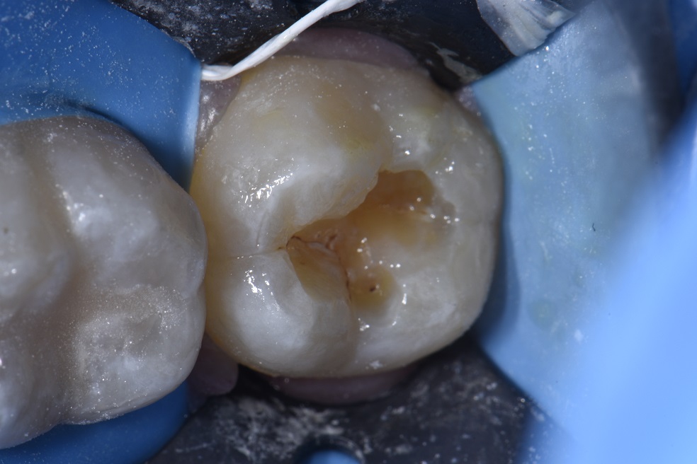 Wisdom teeth restorations