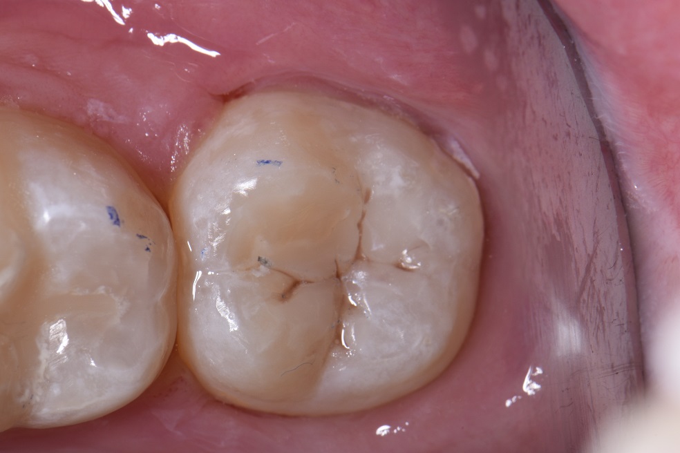Wisdom teeth restorations