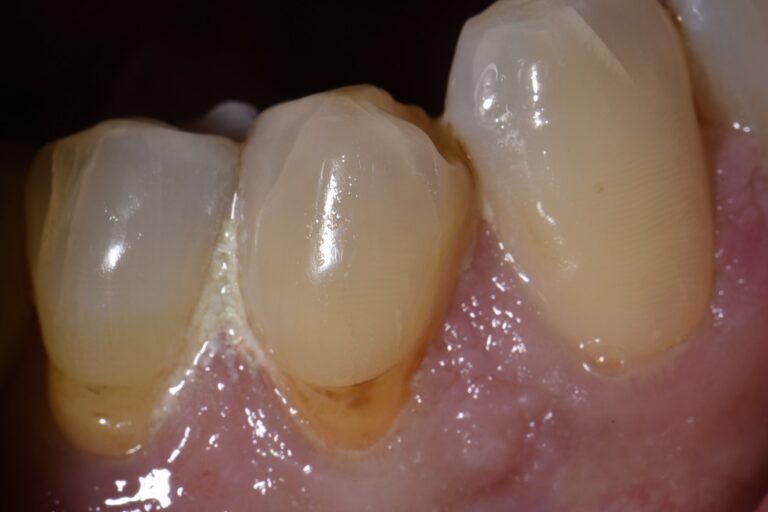 Fillings to lighten dark tooth roots