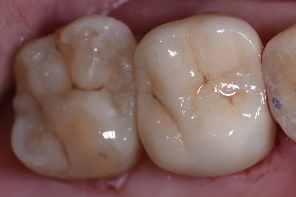Reinforcement of heavily restored teeth with onlay and composite