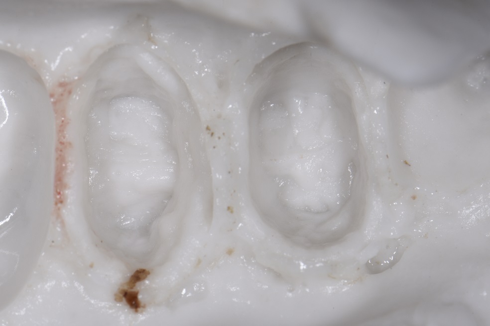 Complex semi-direct reconstruction of Amelogenesis Imperfecta teeth