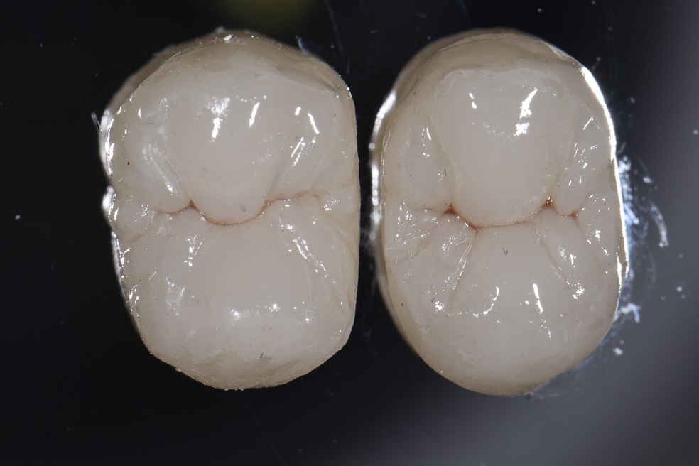 Complex semi-direct reconstruction of Amelogenesis Imperfecta teeth