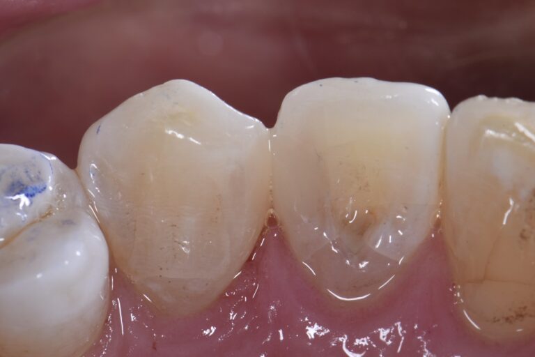 Cavities between front teeth restored invisibly
