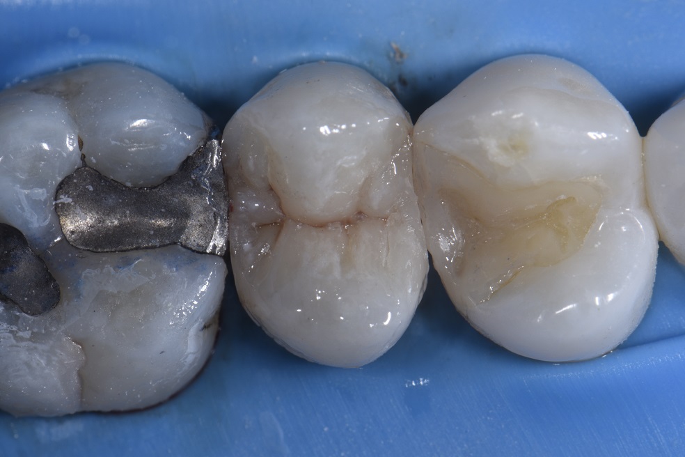 Large old fillings selectively removed and restored