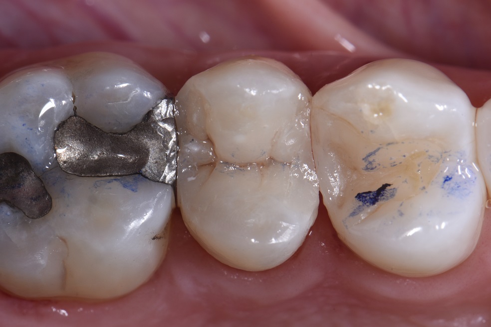 Large old fillings selectively removed and restored