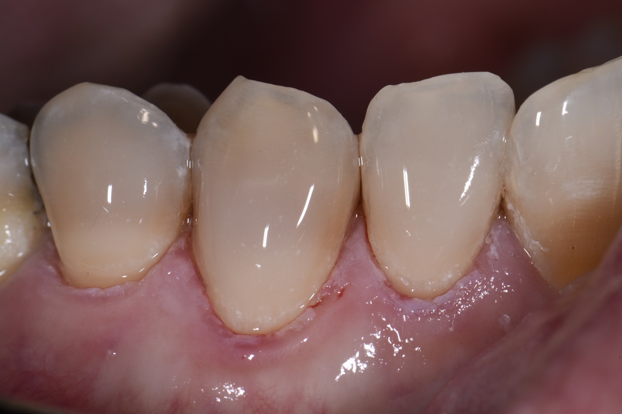 Non-invasive resin bonding on tetracycline stained teeth