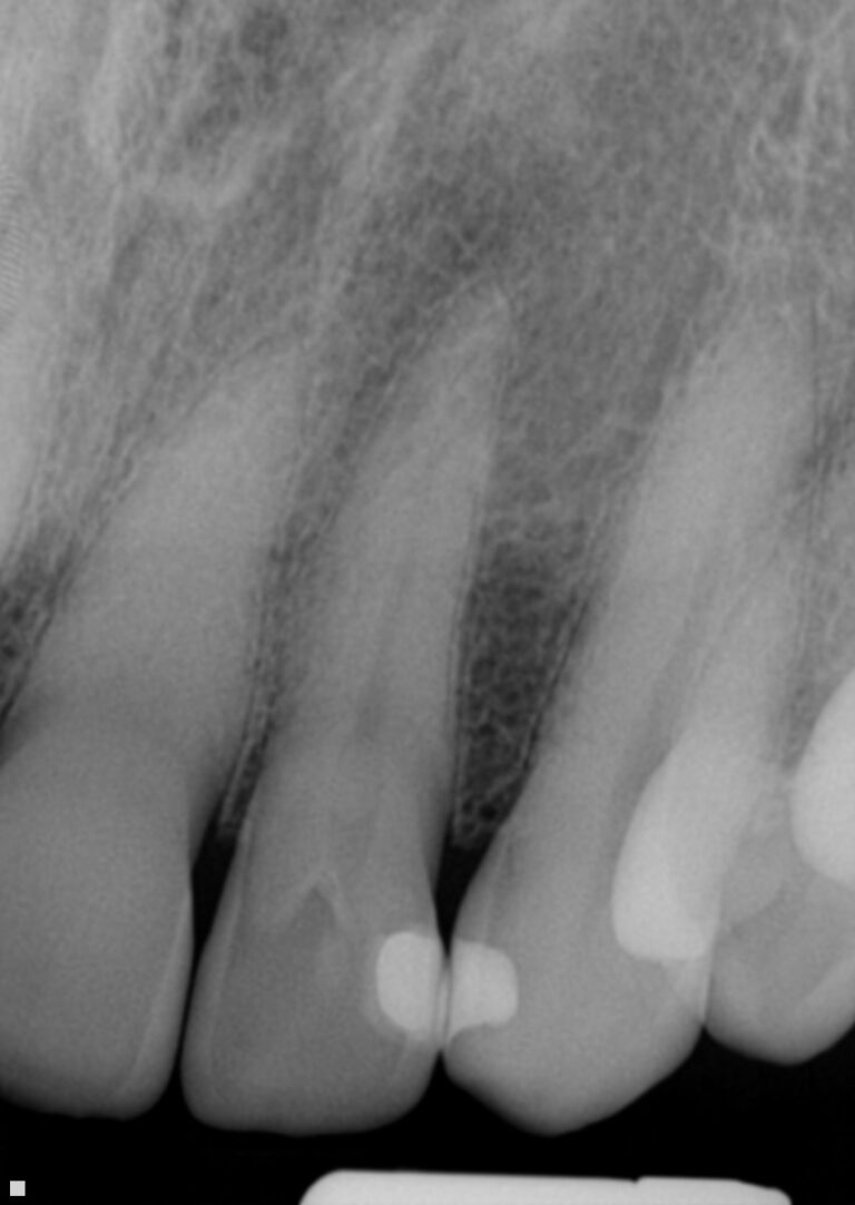 Cavities between front teeth restored invisibly