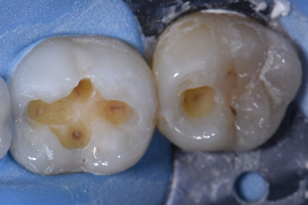 Class I restorations using a Giomer composite resin