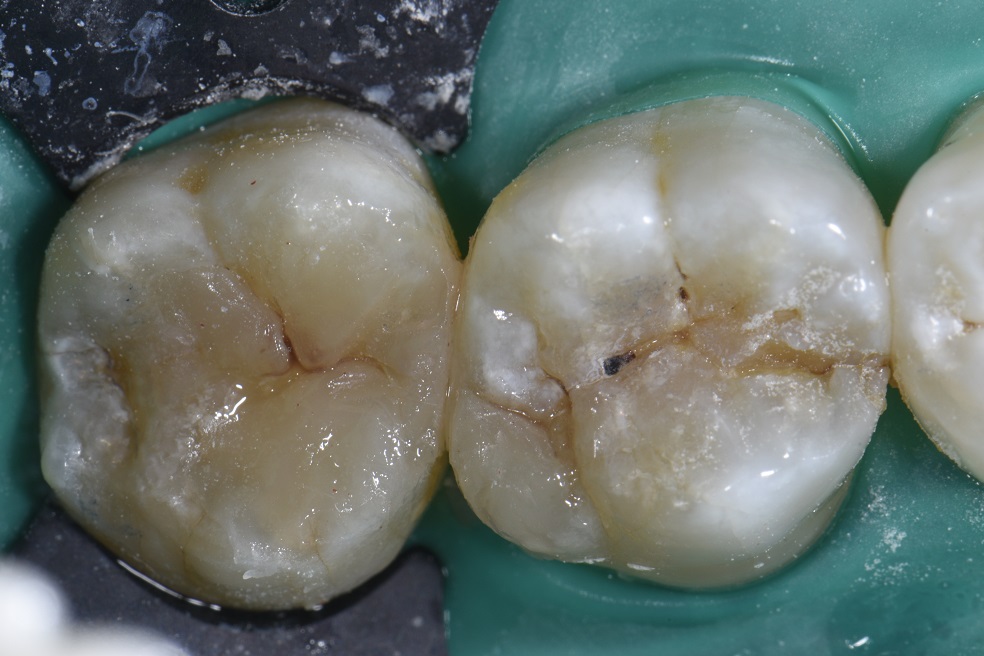 Tooth wear reversed
