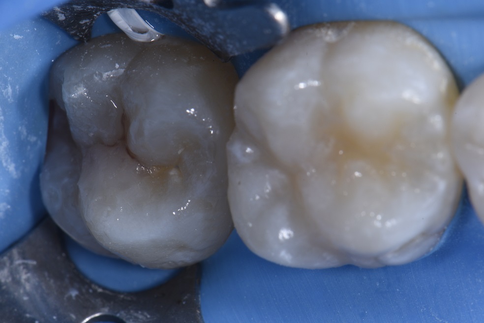 Distally tipped second molar restorations