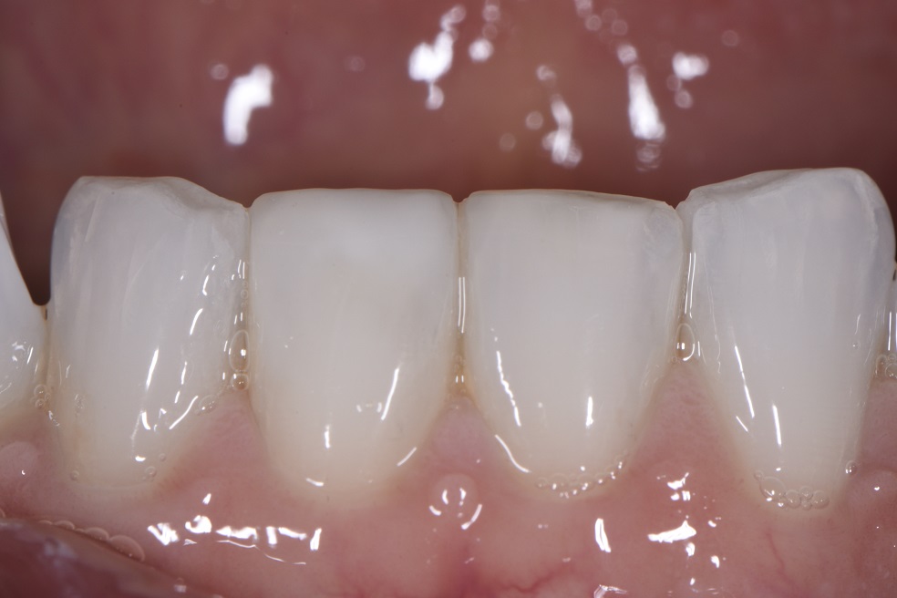 Instant orthodontics using Restorative Rotation