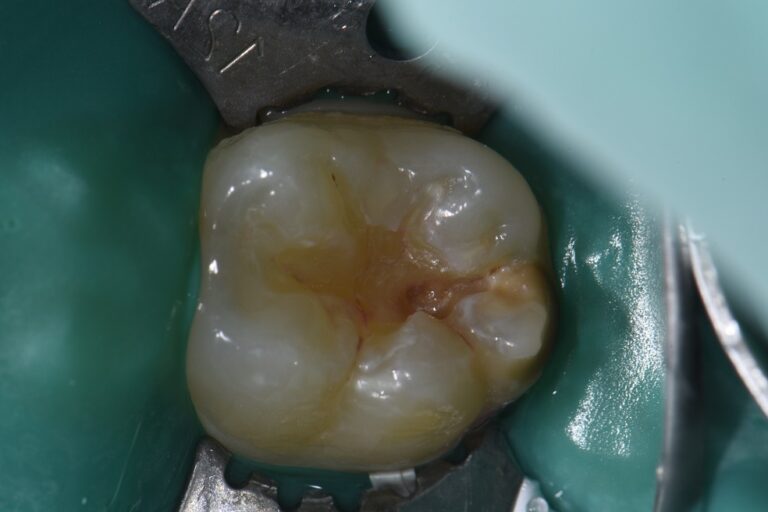 Restoration of a Hypomineralized Molar