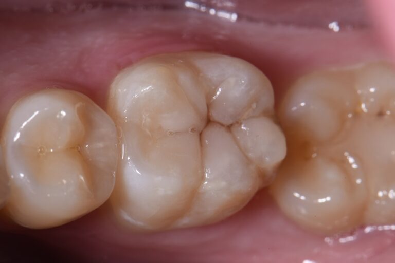 Restoration of a Hypomineralized Molar