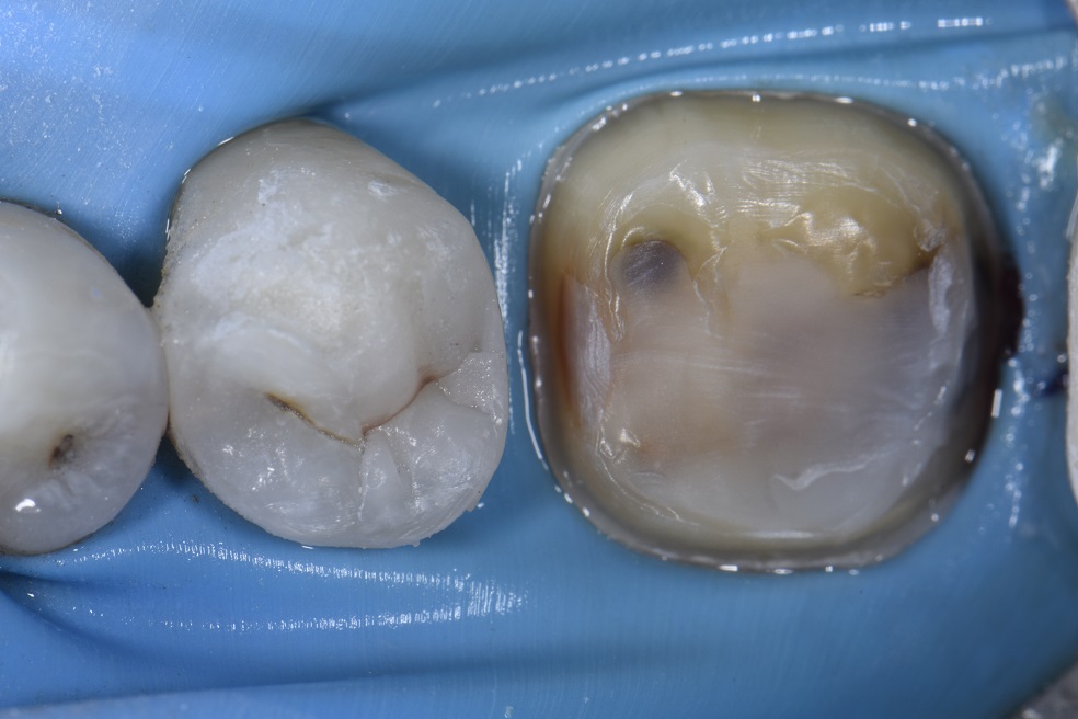 Supporting Cracked Teeth with Minimally Invasive Bonded Crowns