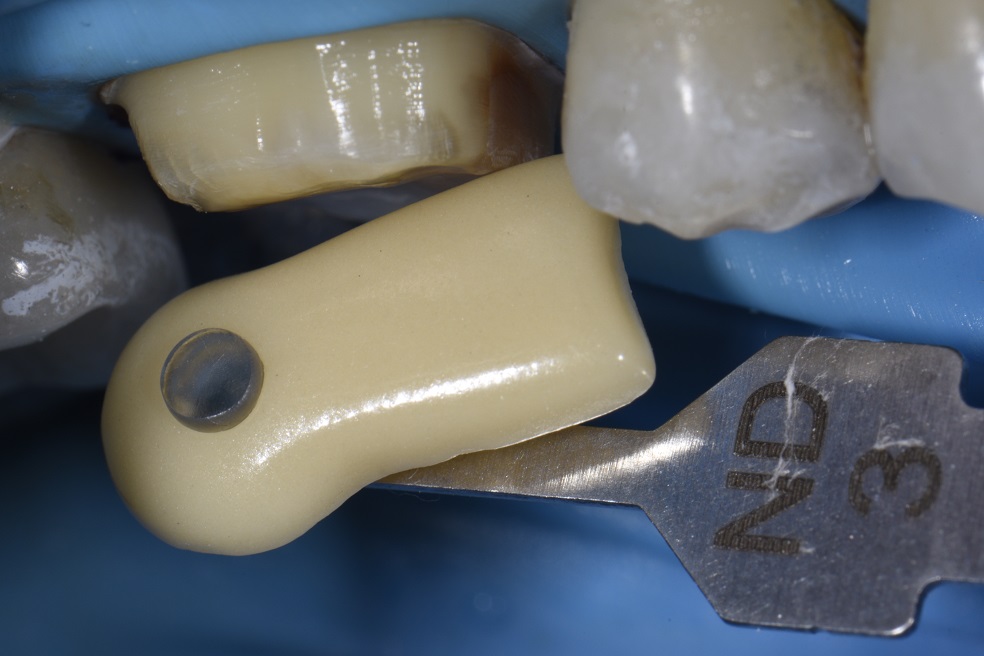 Supporting Cracked Teeth with Minimally Invasive Bonded Crowns