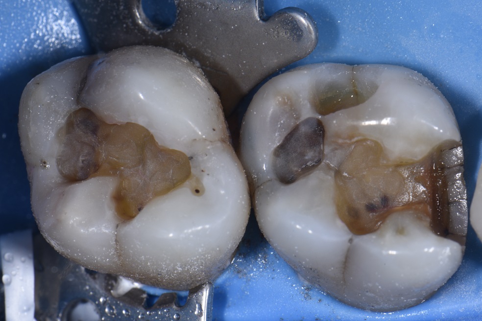 Amalgam stained teeth