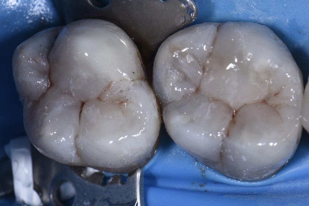 Amalgam stained teeth