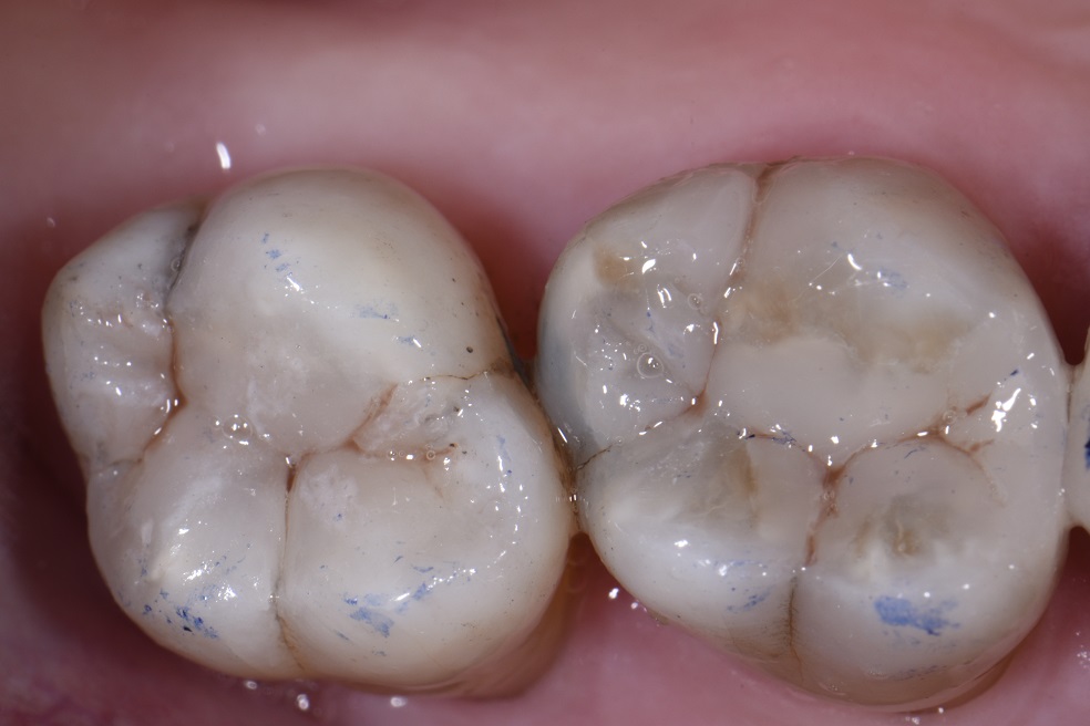 Amalgam stained teeth