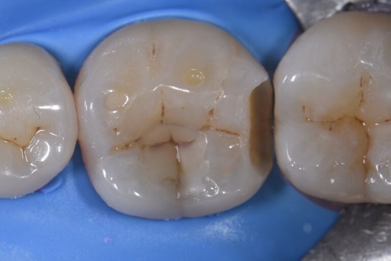 Esthetic Slot Preparation Restorations
